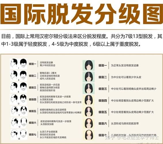 植发后多久可以洗头_植发价格一般多少钱-第3张图片-山城妙识 植发后多久可以洗头_植发价格一般多少钱-第3张图片-山城妙识