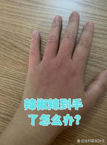 辣椒素会烧伤皮肤吗_辣椒素对皮肤伤害程度-第2张图片-山城妙识 辣椒素会烧伤皮肤吗_辣椒素对皮肤伤害程度-第2张图片-山城妙识