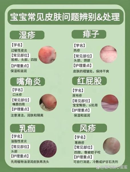 过敏和湿疹的区别_如何判断是过敏还是湿疹-第3张图片-山城妙识