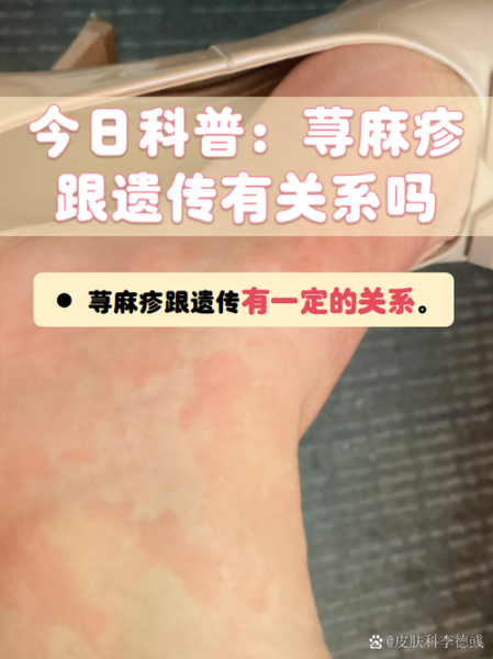 荨麻疹是肝癌的前兆吗_荨麻疹和肝癌的关系-第1张图片-山城妙识 荨麻疹是肝癌的前兆吗_荨麻疹和肝癌的关系-第1张图片-山城妙识
