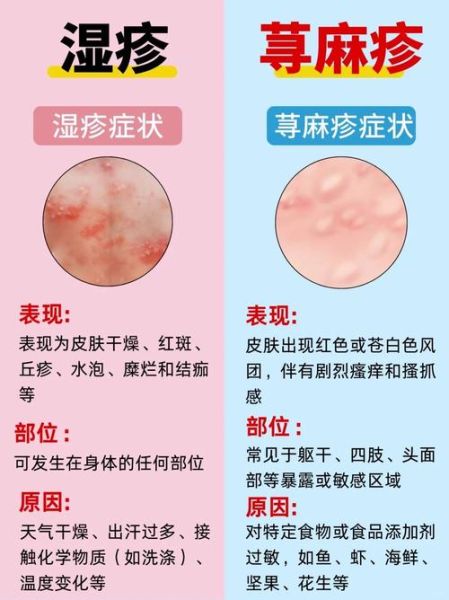 过敏性荨麻疹图片_如何辨别风团与湿疹-第1张图片-山城妙识