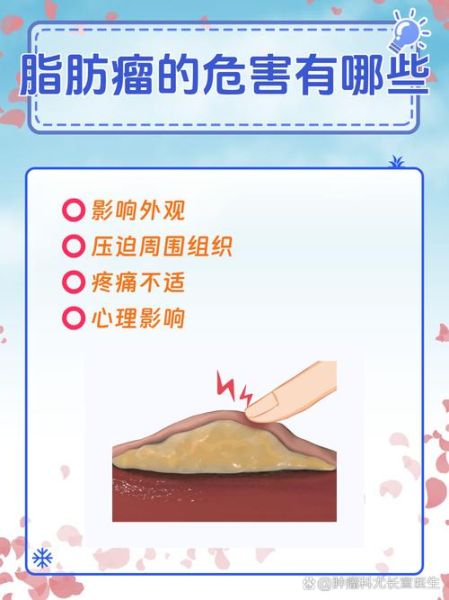 脂肪瘤是怎么形成的_脂肪瘤会自己消失吗-第1张图片-山城妙识 脂肪瘤是怎么形成的_脂肪瘤会自己消失吗-第1张图片-山城妙识