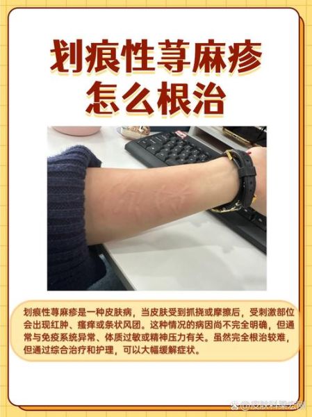 过敏症状有哪些表现_过敏症状怎么缓解-第3张图片-山城妙识