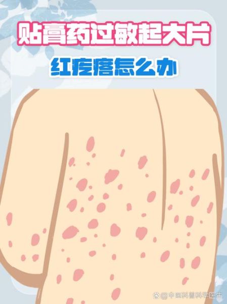 过敏症状有哪些表现_过敏症状怎么缓解-第2张图片-山城妙识