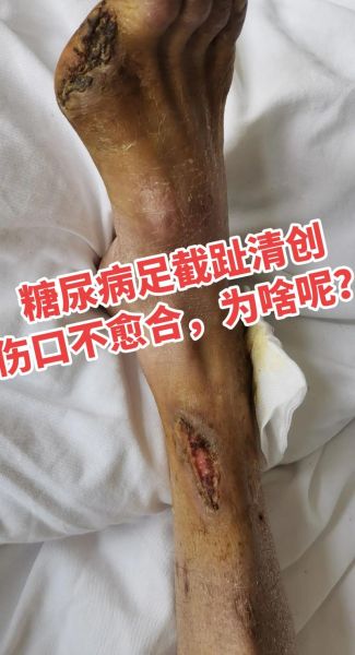 糖尿病有哪些并发症_糖尿病能治愈吗-第3张图片-山城妙识 糖尿病有哪些并发症_糖尿病能治愈吗-第3张图片-山城妙识