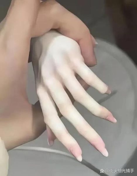 鸡爪手图片_鸡爪手怎么矫正-第2张图片-山城妙识 鸡爪手图片_鸡爪手怎么矫正-第2张图片-山城妙识