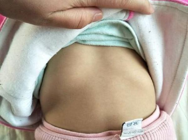 儿童鸡胸的症状有哪些_鸡胸图片怎么看-第1张图片-山城妙识 儿童鸡胸的症状有哪些_鸡胸图片怎么看-第1张图片-山城妙识