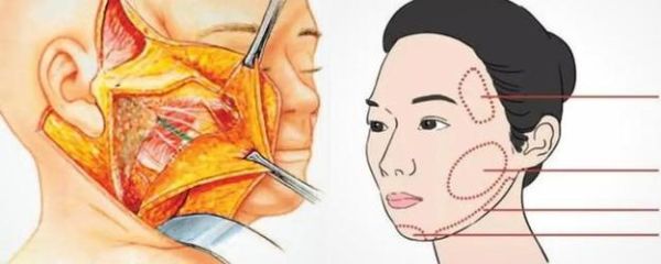 美容拉皮是怎么做的_拉皮手术全过程-第2张图片-山城妙识 美容拉皮是怎么做的_拉皮手术全过程-第2张图片-山城妙识