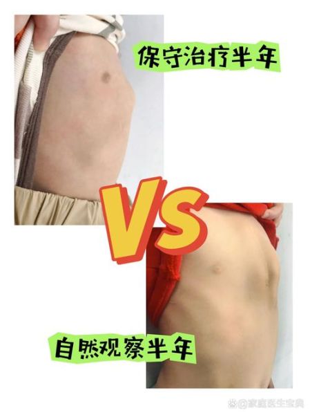 鸡胸宝宝平躺图片_鸡胸宝宝平躺睡觉正常吗-第2张图片-山城妙识