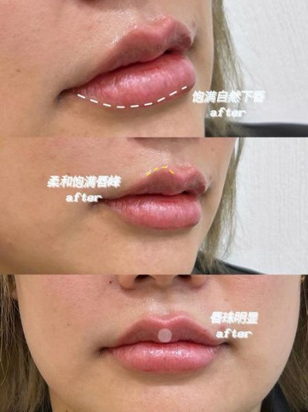 香肠嘴怎么改善_厚唇变薄自然方法-第1张图片-山城妙识