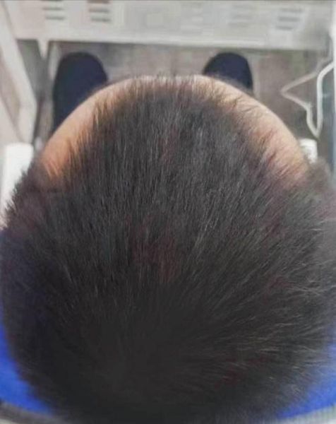 脂溢性脱发早期图片_怎么判断-第3张图片-山城妙识 脂溢性脱发早期图片_怎么判断-第3张图片-山城妙识