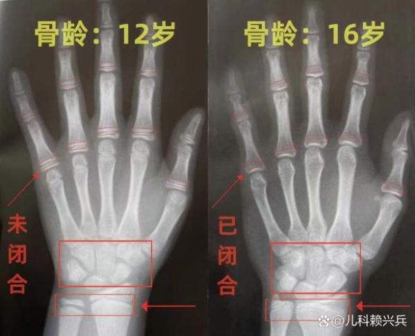 身高不长了的前兆_如何判断骨骼线闭合-第2张图片-山城妙识 身高不长了的前兆_如何判断骨骼线闭合-第2张图片-山城妙识