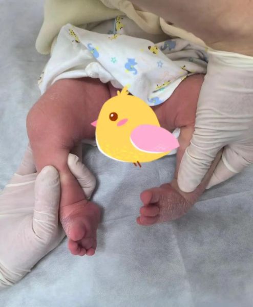 马蹄足内翻是什么原因_马蹄足内翻会遗传吗-第1张图片-山城妙识 马蹄足内翻是什么原因_马蹄足内翻会遗传吗-第1张图片-山城妙识