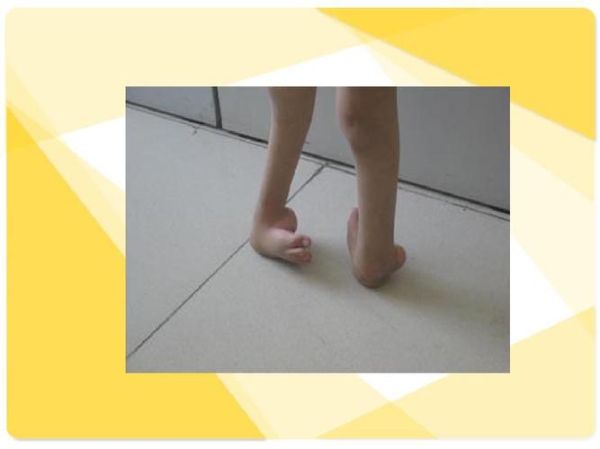 马蹄足内翻是什么原因_马蹄足内翻会遗传吗-第2张图片-山城妙识 马蹄足内翻是什么原因_马蹄足内翻会遗传吗-第2张图片-山城妙识