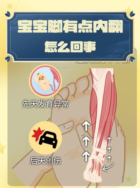 马蹄足内翻是什么原因_马蹄足内翻会遗传吗-第3张图片-山城妙识 马蹄足内翻是什么原因_马蹄足内翻会遗传吗-第3张图片-山城妙识