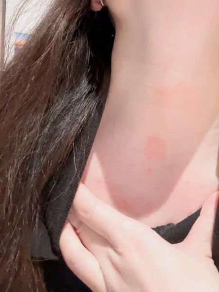 蚕豆病皮肤症状图片_如何识别典型皮疹-第1张图片-山城妙识 蚕豆病皮肤症状图片_如何识别典型皮疹-第1张图片-山城妙识