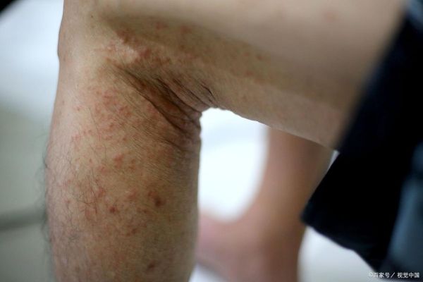 蚕豆病皮肤症状图片_如何识别典型皮疹-第3张图片-山城妙识 蚕豆病皮肤症状图片_如何识别典型皮疹-第3张图片-山城妙识