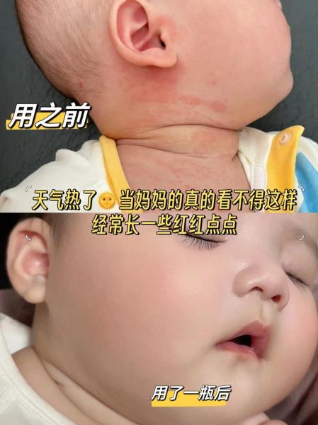 艾蒿过敏症状有哪些_艾蒿过敏怎么办-第3张图片-山城妙识