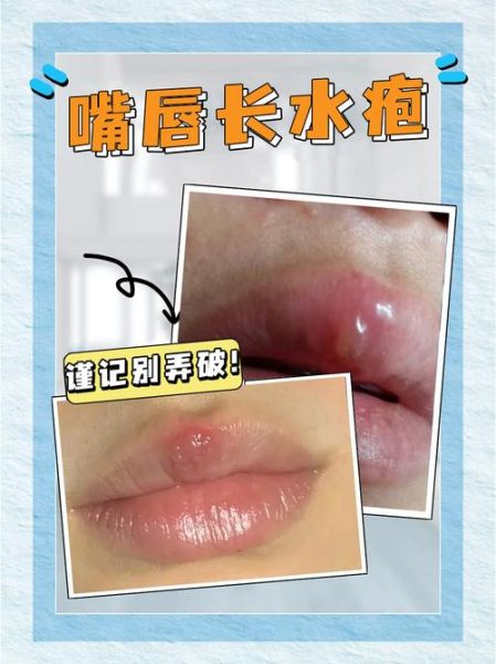 一夜之间嘴唇上起泡是什么原因_嘴唇起泡怎么办-第2张图片-山城妙识