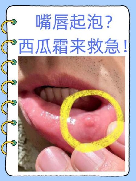 一夜之间嘴唇上起泡是什么原因_嘴唇起泡怎么办-第1张图片-山城妙识