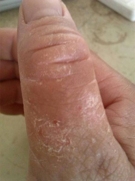 鹅掌风病图片_鹅掌风初期症状有哪些-第3张图片-山城妙识