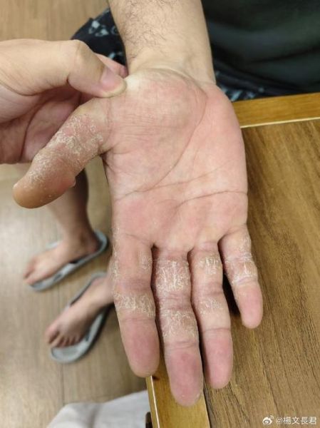 鹅掌风病图片_鹅掌风初期症状有哪些-第2张图片-山城妙识