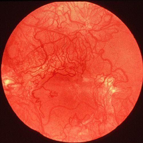 脉络膜新生血管能治好吗_如何预防复发-第2张图片-山城妙识