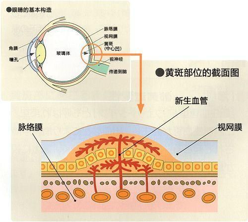 脉络膜新生血管能治好吗_如何预防复发-第3张图片-山城妙识