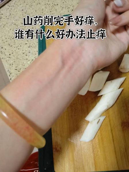 切完山药手痒怎么办_山药粘液过敏止痒妙招-第2张图片-山城妙识 切完山药手痒怎么办_山药粘液过敏止痒妙招-第2张图片-山城妙识