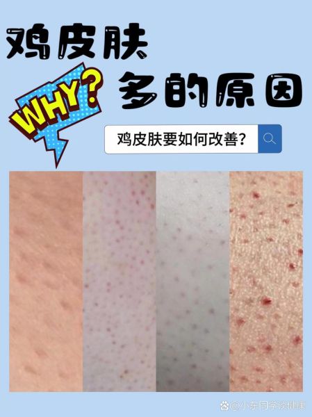 鸡皮肤会自己消失吗_鸡皮肤多久能好-第2张图片-山城妙识