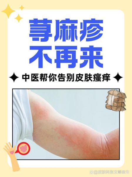 荨麻疹最怕三样东西_荨麻疹怎么快速止痒-第1张图片-山城妙识 荨麻疹最怕三样东西_荨麻疹怎么快速止痒-第1张图片-山城妙识