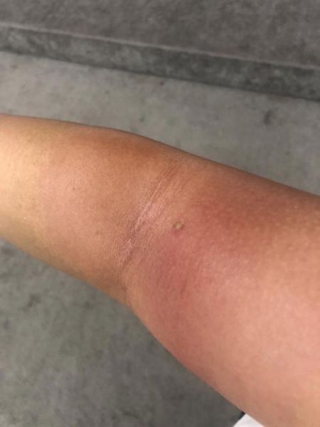 马蜂窝怎么处理掉_被马蜂蜇了怎么办-第3张图片-山城妙识