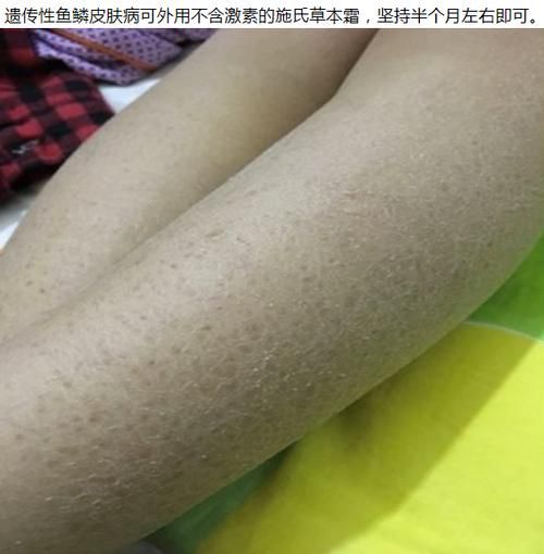 鱼鳞病会遗传吗_鱼鳞病怎么治最好-第1张图片-山城妙识