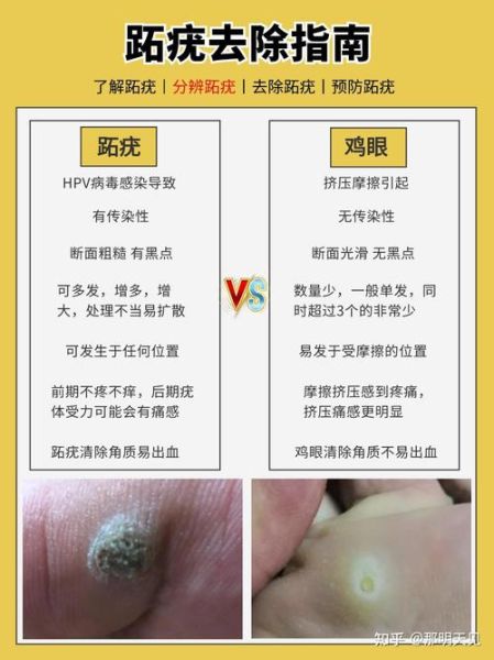 鸡眼是怎么形成的_鸡眼和跖疣的区别-第2张图片-山城妙识 鸡眼是怎么形成的_鸡眼和跖疣的区别-第2张图片-山城妙识