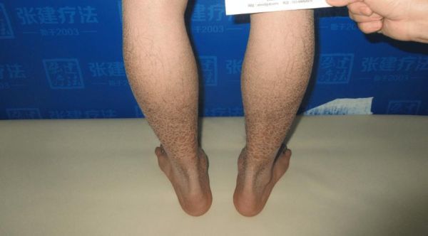 鱼鳞病会遗传吗_鱼鳞病怎么治最好-第3张图片-山城妙识