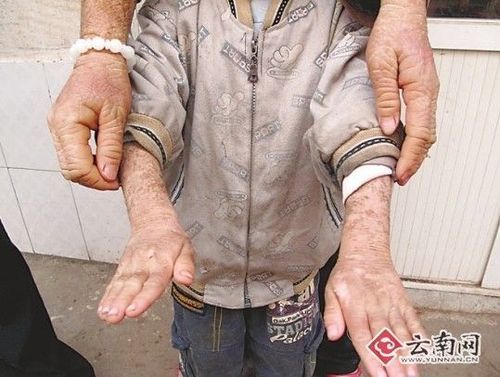 鱼鳞病会遗传吗_鱼鳞病怎么治最好-第2张图片-山城妙识