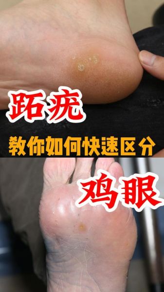 鸡眼是怎么形成的_鸡眼和跖疣的区别-第1张图片-山城妙识 鸡眼是怎么形成的_鸡眼和跖疣的区别-第1张图片-山城妙识