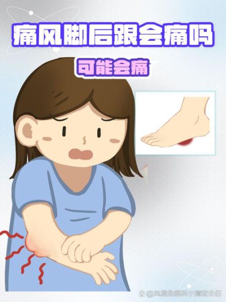 脚疼是不是痛风_痛风脚疼怎么判断-第3张图片-山城妙识 脚疼是不是痛风_痛风脚疼怎么判断-第3张图片-山城妙识