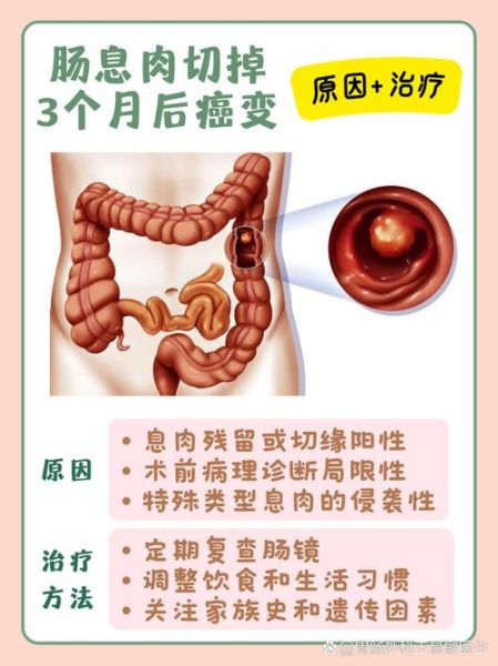 结肠息肉会癌变吗_结肠息肉切除后复发吗-第1张图片-山城妙识 结肠息肉会癌变吗_结肠息肉切除后复发吗-第1张图片-山城妙识