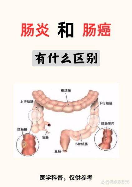 肠炎和肠癌的症状区别_怎么区分-第3张图片-山城妙识