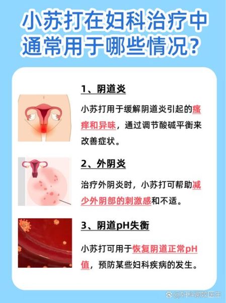 妇科炎症用小苏打有用吗_正确使用方法-第2张图片-山城妙识