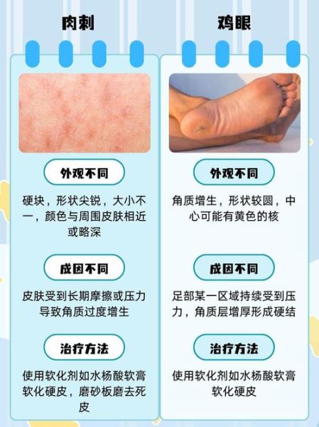 肉刺和鸡眼的区别图片_怎么分辨-第2张图片-山城妙识
