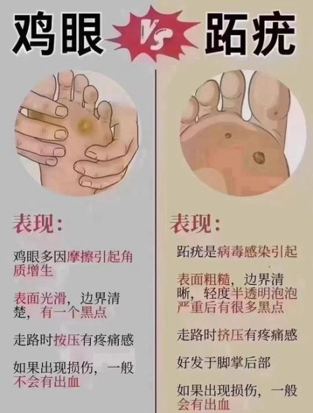 肉刺和鸡眼的区别图片_怎么分辨-第3张图片-山城妙识