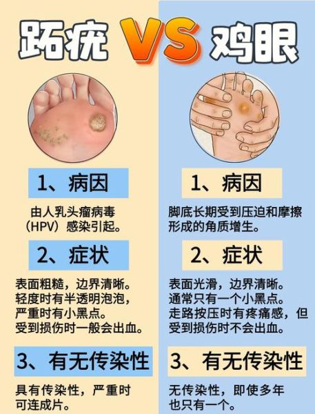 肉刺和鸡眼的区别图片_怎么分辨-第1张图片-山城妙识