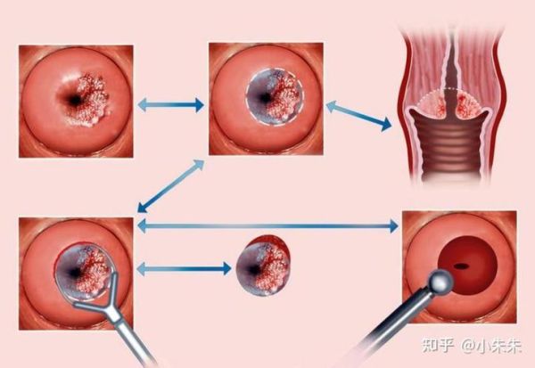 醋酸白试验多少钱_做一次需要多长时间-第3张图片-山城妙识 醋酸白试验多少钱_做一次需要多长时间-第3张图片-山城妙识