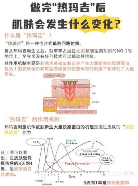 热玛吉的作用与功效_热玛吉做一次能维持多久-第2张图片-山城妙识 热玛吉的作用与功效_热玛吉做一次能维持多久-第2张图片-山城妙识