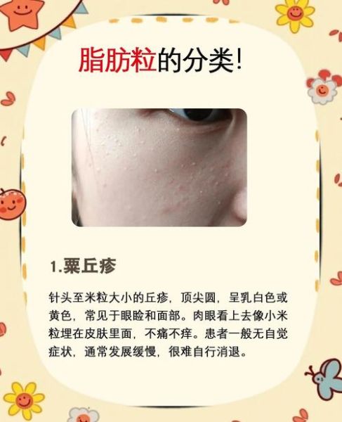 脂肪粒怎么去除_脂肪粒和粉刺的区别-第2张图片-山城妙识 脂肪粒怎么去除_脂肪粒和粉刺的区别-第2张图片-山城妙识