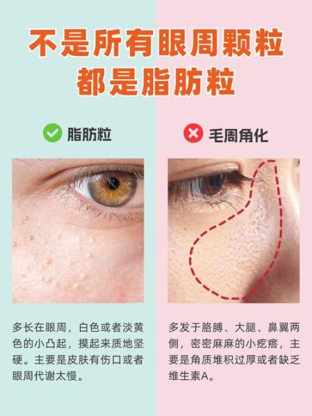 脂肪粒怎么去除_脂肪粒和粉刺的区别-第3张图片-山城妙识 脂肪粒怎么去除_脂肪粒和粉刺的区别-第3张图片-山城妙识