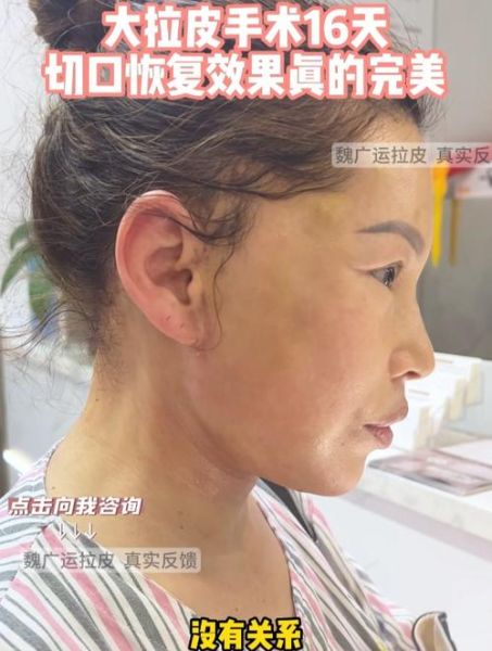 大拉皮手术15天照片_恢复期多久-第1张图片-山城妙识 大拉皮手术15天照片_恢复期多久-第1张图片-山城妙识