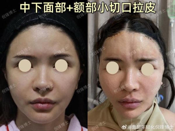 大拉皮手术15天照片_恢复期多久-第3张图片-山城妙识 大拉皮手术15天照片_恢复期多久-第3张图片-山城妙识